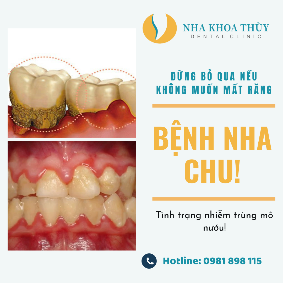 Bệnh Nha Chu