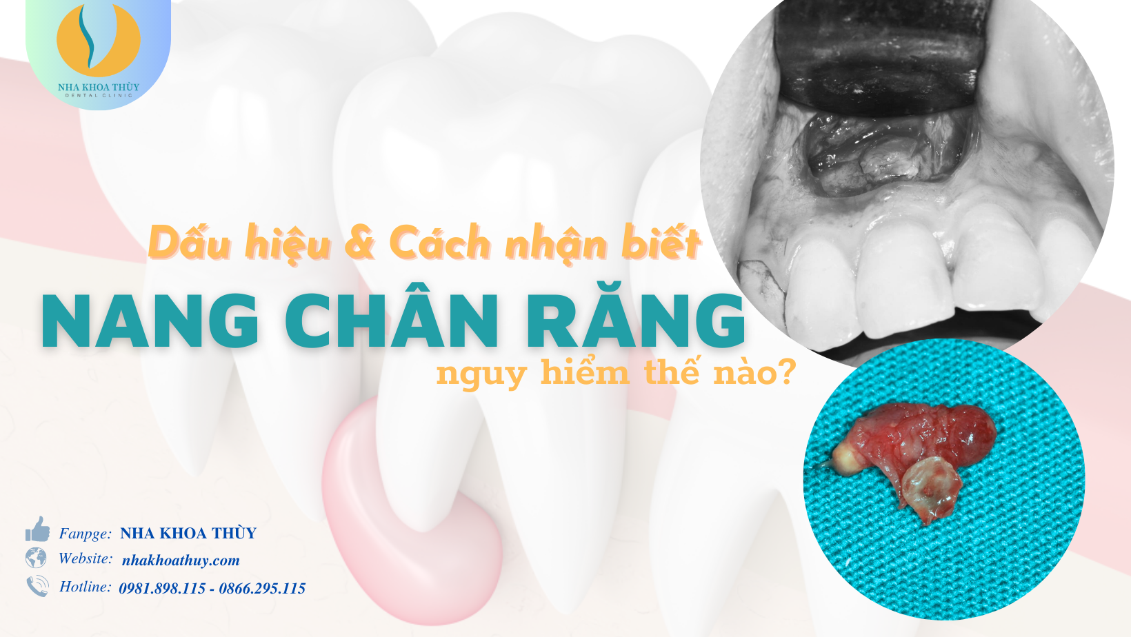 Nang chân răng nguy hiểm như thế nào